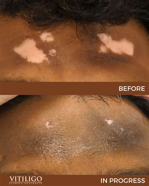 Vitiligo Ne Demek Vitiligo Nedir Belirtileri Nedenleri Ve Tedavisi