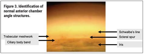 Gonioscopy And The Art Of Catching Narrow Angles