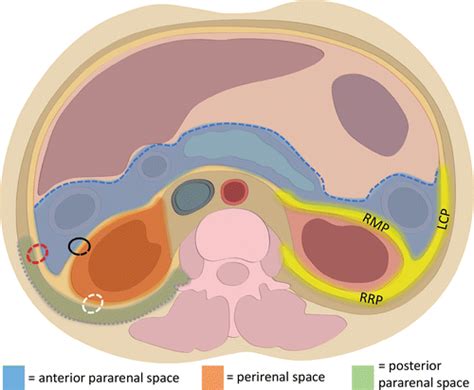 Radiologic Pathologic Correlation Of Primary Retroperitoneal Neoplasms