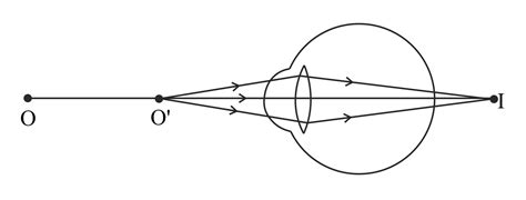 What Is Hypermetropia Give Its Causes Explain With The Help Of A Labelled Ray Diagram How It Is