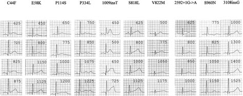 Notched T Wave Benign Early Repolarization Wikipedia