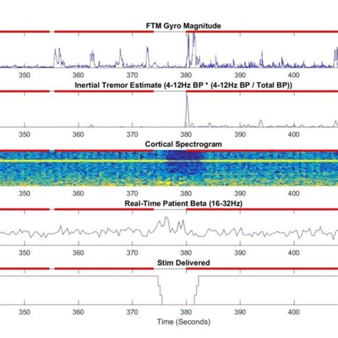 Time Plots Of The Patients Inertial Sensor Tremor Estimate Cortical