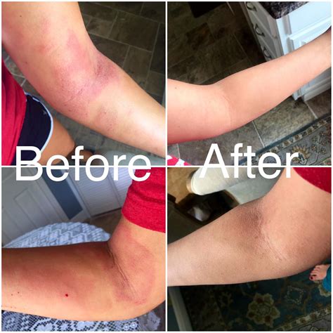 85 Best Dupixent Images On Pholder Eczema Ecze Ma Bs And Commercials I Hate