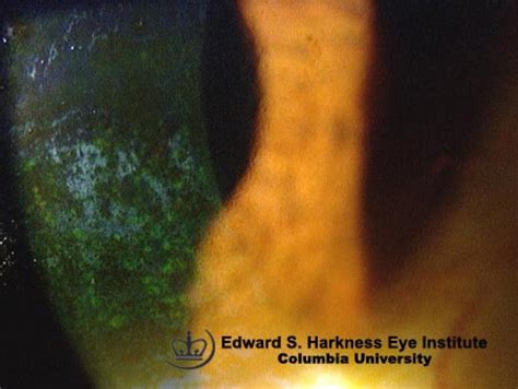 Epithelial Staining In Graft Versus Host Disease Vagelos College Of