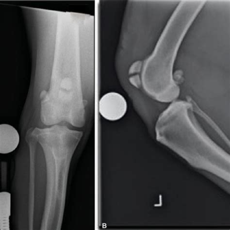 A Neer And Rockwood Classification Of Distal Clavicle Fracture Iia