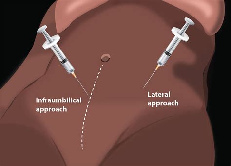 Sonoguide Paracentesis