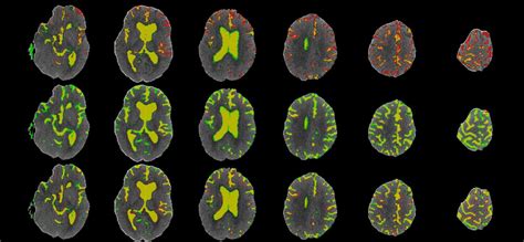 Demonstration Of Csf Segmentation Results Using Hounsfield Unit Download Scientific Diagram