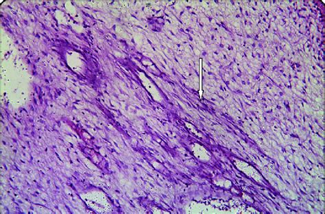 Photomicrograph Of Subgroup B Conventional Depth Cavities Filled With Download Scientific