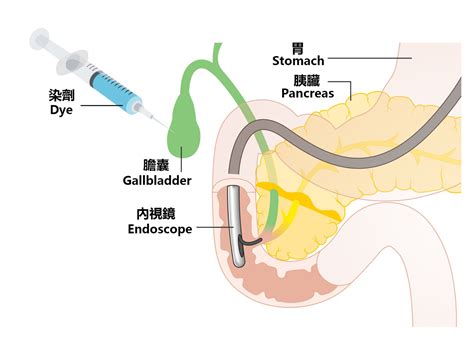 Ercp Procedure Bile Duct Stent Preventing Pancreatitis After Ercp