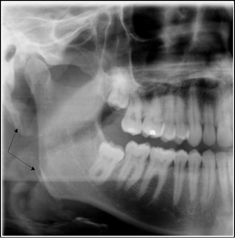 Prominent Elongation Of The Segmented And Pseudo Articulated Variant Download Scientific Diagram