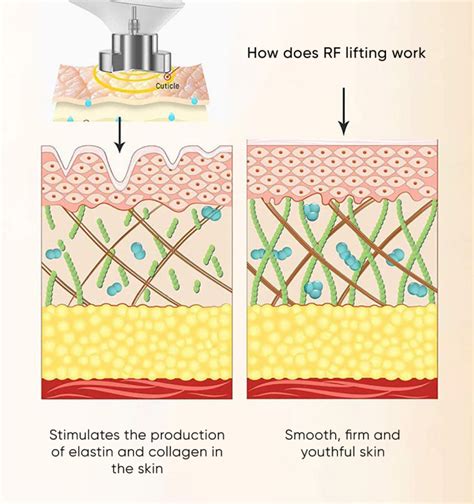 What Is Rf Skin Tightening How Does Rf Skin Tightening Work