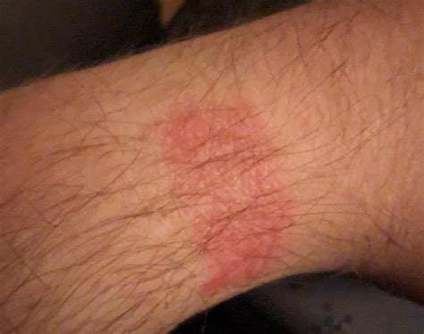 Garmin Rash Kudos To Garmin Support R Garmin