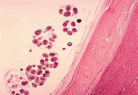 Echinococcus Granulosus Hydatid Cyst