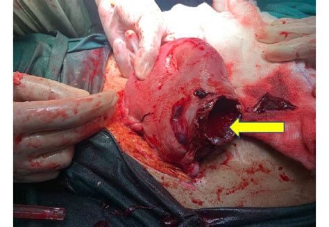 Intraoperative Image Showing Cornual Rupture Download Scientific Diagram
