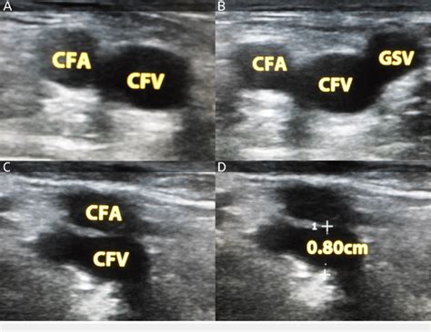 Femoral Artery Ultrasound