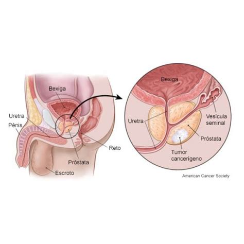 Próstata Urotarget