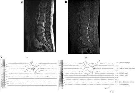 Case 2 Preoperative Lumbosacral Spine Mri A T2 Weighted B