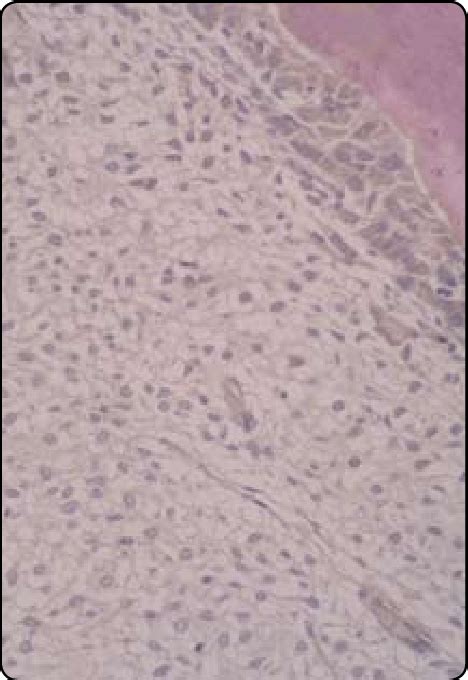 Immunoperoxidase Staining With S100 Polyclonal Antibody Counterstained Download Scientific