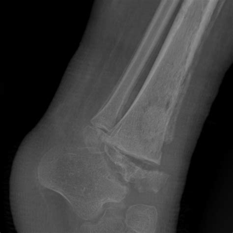 Osteomyelitis X Ray Sequestrum