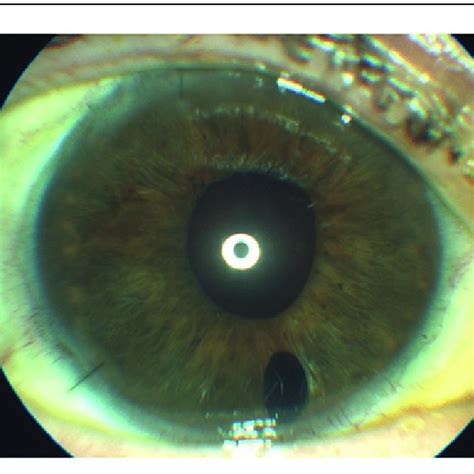 Anterior Segment Photograph Of The Right Eye Of The Patient Described Download Scientific