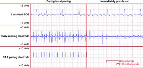 Assessment Of Atrial Arrhythmogenic Substrate Via Transvenous Pacing Of