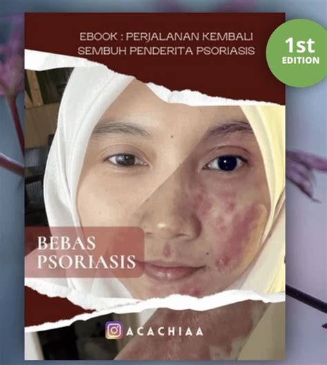 Psoriasis Semakin Pulih Rawatan Psoriasis Malaysia Rbebaspsoriasis