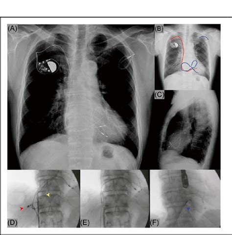 A Chest Radiograph Shows The Alpha Looped Broken Pacemaker Lead B Download Scientific