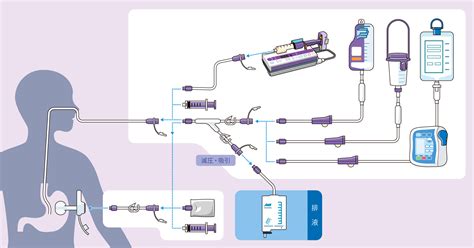 iso80369 3経腸栄養分野の小口径コネクタの変更について 対象製品 jms 医療関係者向けサイト