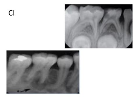 Direct And Indirect Pulp Capping Pptx