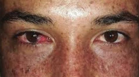 Xeroderma Pigmentosum