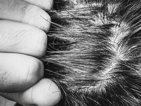 Dry Scalp Causes And Treatment Options