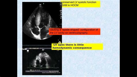 Echo Myocardial Disease Atlas Youtube