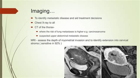Endometrial Cancer Ppt