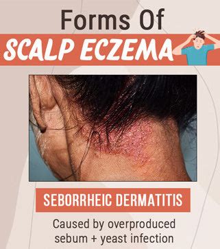 Scalp Eczema Causes Symptoms Treatments And Preventive Tips Vedix