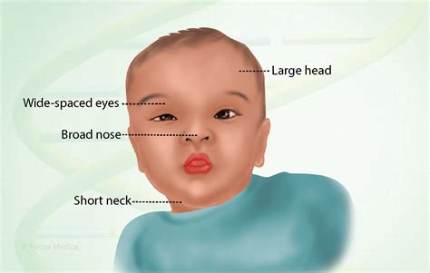 Noonan Syndrome Causes Symptoms Diagnosis And Treatment
