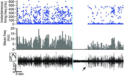 Cessation Of Stn Neuron Firing After Microstimulation Microstimulation
