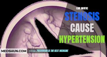 The Link Between Aortic Stenosis And The Development Of Aortic Aneurysm MedShun
