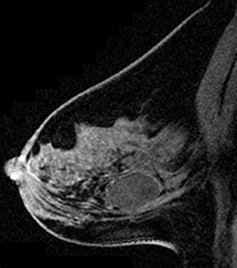 Male Cyst Breast At Ella Hogarth Blog