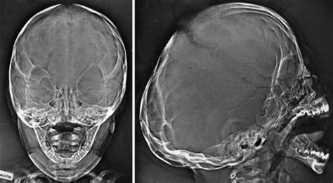 Lambdoid Suture X Ray