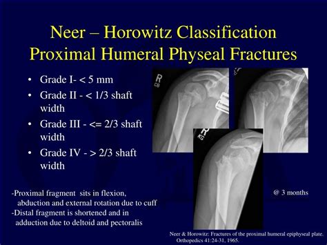 Ppt Fractures And Dislocations About The Shoulder In The Pediatric