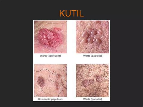 Bahaya Penyakit Menular Seksual Pada Remaja Pptx