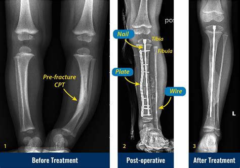 Broken Tibia Surgery