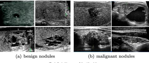 Figure 1 From A Pre‐trained Convolutional Neural Network Based Method For Thyroid Nodule