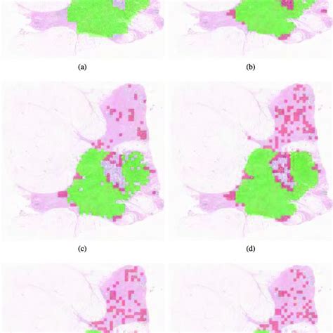 Results For The Idc Detection True Positive And False Positive Patches