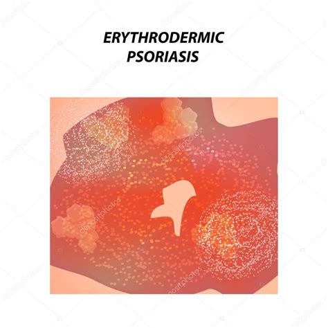 Psoriasis Eritrodérmica Eczema Dermatitis Psoriasis De La Piel
