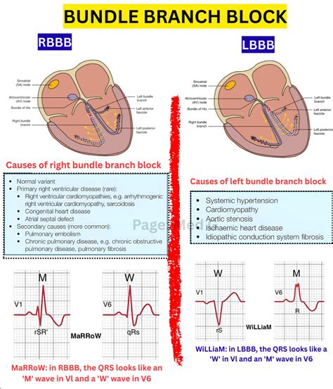 Med Bundle Branch Block Bbb Your Hearts Electrical Signal Travels