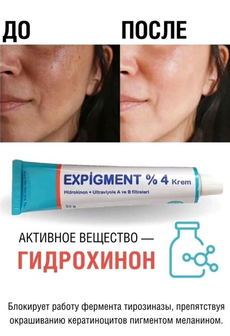 Экспигмент Expigment от ПИГМЕНТАЦИИ,для лечения пигментных: 850 KGS ...