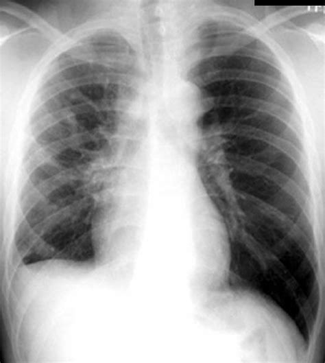 Dark Lung Fields