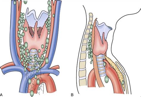 Thyroidectomy And Parathyroidectomy Basicmedical Key