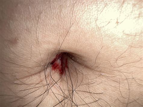 Belly Button Bleeding Rmedicaladvice
